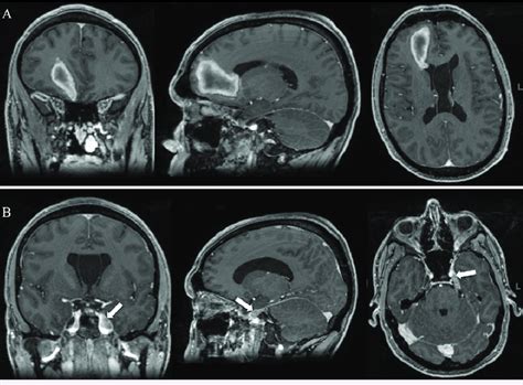 T1 Postcontrast Mri Of The Brain A Rim Enhancing Right Frontal Lesion Download Scientific