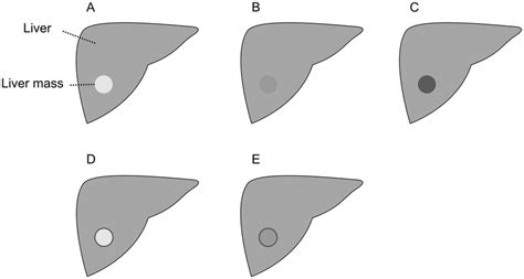 Different Echo Pattern Of Homogenous Liver Masses In Ultrasound B Mode