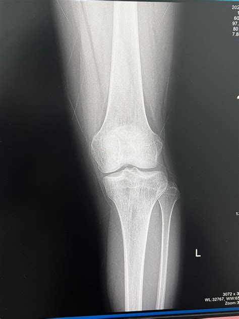 무릎 X Ray 지식in