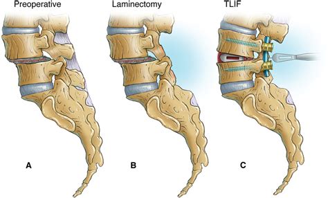 Laminectomy Decompression