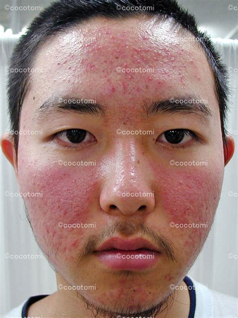 脂漏性皮膚炎読み方 脂漏性皮膚炎の治し方 Gdmsv