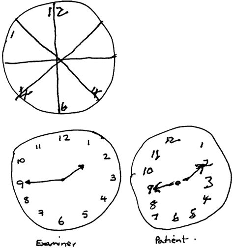 Clock Drawing Test Examples Warehouse Of Ideas