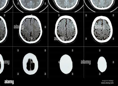 multi slice ct scan of the brain showing large brain stem and right