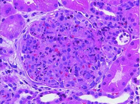 Postinfectious Glomerulonephritis Concise Medical Knowledge