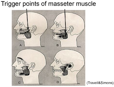 Trigger Point Of Masseter Muscle Download Scientific Diagram