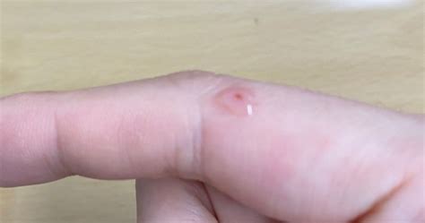 [보건실 꿀팁][보건실 꿀템] 보건교사가 알려주는 균을 없애주고 막아주어 새 살이 빨리 돋아나게 하는 도다나겔 티로트리신 네이버 블로그