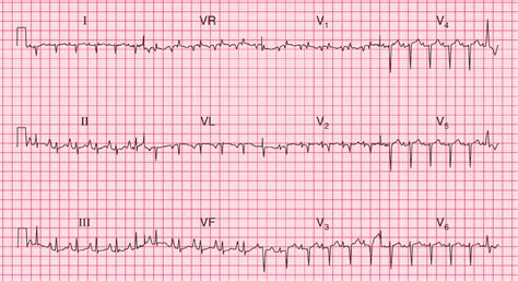 Ecg Case 147 Digoxin Effect With Possible Digoxin Toxicity Manual Of