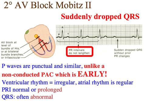 Av Blocks Diagram For Ekg Analysis