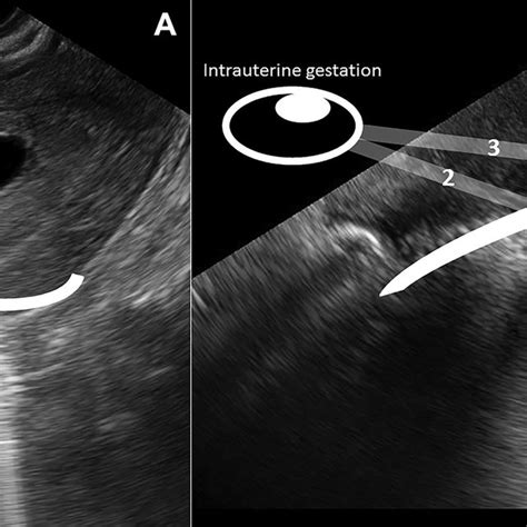 Hemoperitoneum From Ruptured Heterotopic Pregnancy Covering Ovarian Cyst Download Scientific