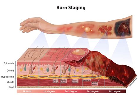 Burn Staging Illustration By Suzanne Hayes Medical Illustration