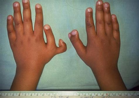 Deformities And Genetic Mutations 32 Photos Klyker Com