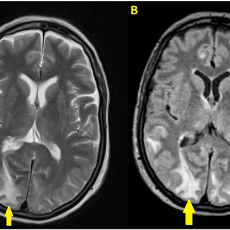 Magnetic Resonance Imaging Of Brain With Contrast Demonstrating Diffuse