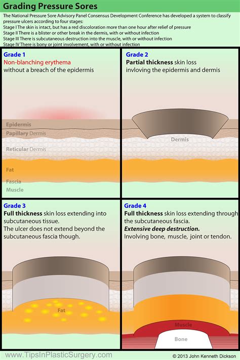 Pressure Sores Tipsinplasticsurgery