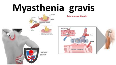 Neuromuscular Junction Myasthenia Gravis
