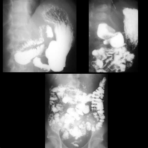 Malrotation With Midgut Volvulus Pediatric Radiology Reference Article Pediatric Imaging