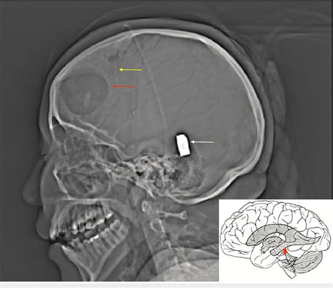 Ct Head Scout Image Demonstrates The Migration Of The Bullet White