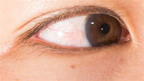 Pterygium And Pinguecula Removal London Hertfordshire And Essex
