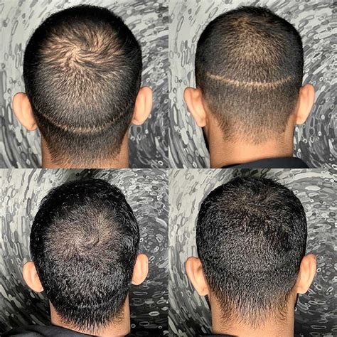 Scar Micropigmentation In Kansas City Mo Scalp Headquarters