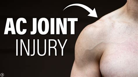 Rockwood Classification Of Acromioclavicular Joint Injuries Download