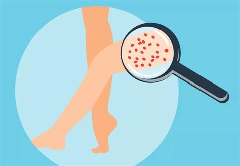 Razor Rash On Legs