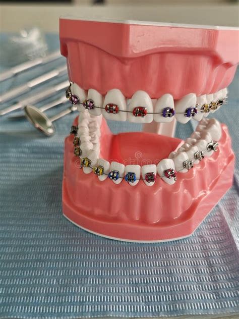 Orthodontic Model Showcasing Colorful Braces In A Dental Office Stock