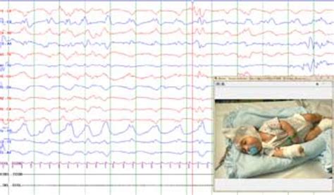 Frontiers Current And Future Uses Of Continuous Eeg In The 55 Off