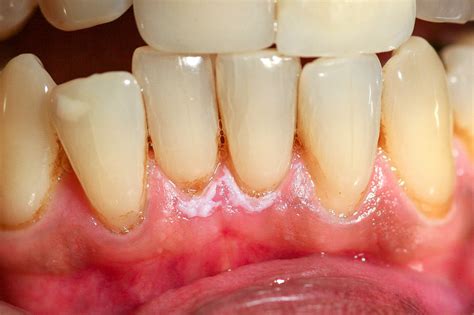 Proliferative Verrucous Leukoplakia