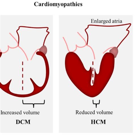 Scheme Demonstrating The Morphological Features Of Hcm Dcm And Rcm Download Scientific Diagram
