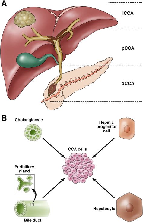 Pathogenesis Diagnosis And Management Of Cholangiocarcinoma