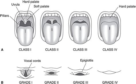 Mallampati Classification Airway Obstruction Soft Pal