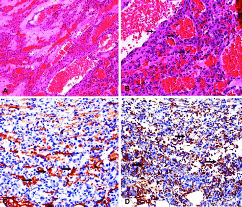 Histopathology Of The Extradural Mass Including 103 A And 203 B