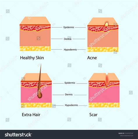 Vector Illustration Types Skin Problems Isolated Stock Vector Royalty Free 1510727147