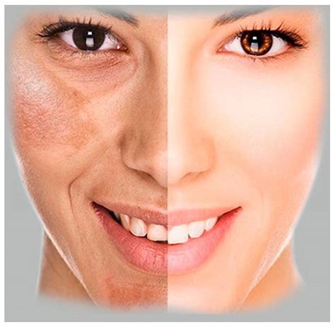 Что такое пигментные пятна причины и лечение МЦ Лазерсвiт