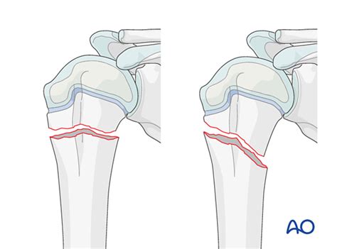 Simple Complete Metaphyseal Fracture