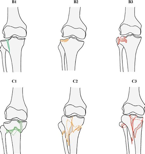 Ao Classification Of Tibia Plateau Fractures B And B My Xxx Hot Girl