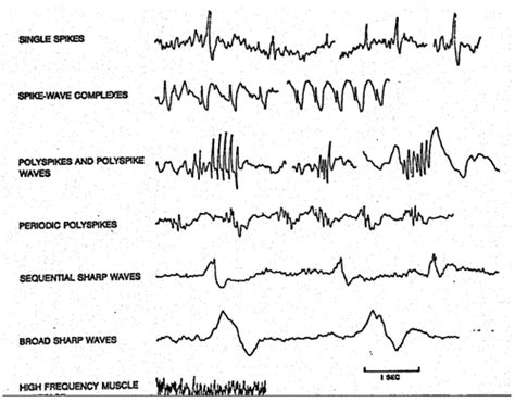 Normal Versus Abnormal Eeg
