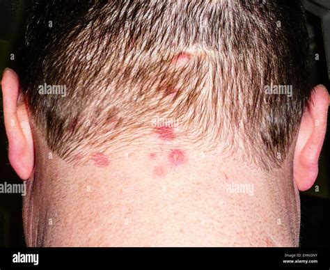 Dermatitis On Your Face At Nettie Cox Blog