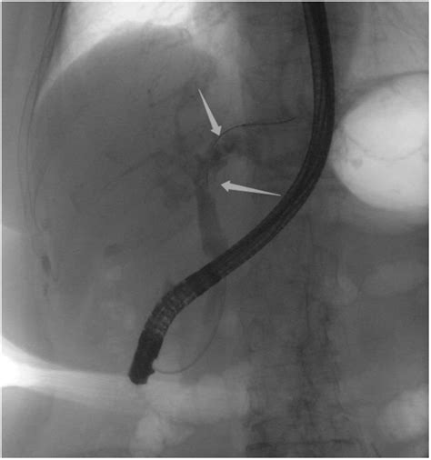 Endoscopic Retrograde Cholangiopancreatography Indicating Multiple