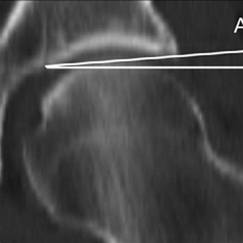 The Acetabular Index Angle Aa Angle Lateral Tilt Of The Acetabulum