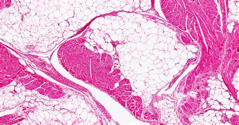 Myocardial Fibrosis Symptoms Diagnosis And Treatment Oklahoma