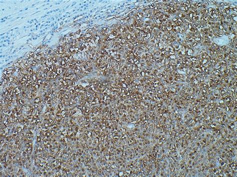Sox10 Immunohistochemistry Showing Nuclear Stain Staining Confirming