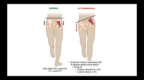 Trendelenburg Positive