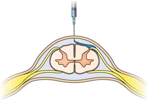 Neurolytic Blocks Anesthesia Key