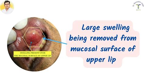 Huge Swelling Being Removed From Mucosal Surface Of Upper Lip Youtube