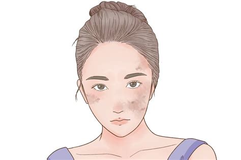 黑色素沉淀怎么去除图片 医疗图片素材 高清图片素材