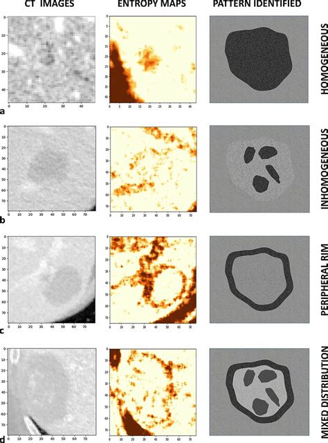patterns of entropy distribution into the tumors after qualitative