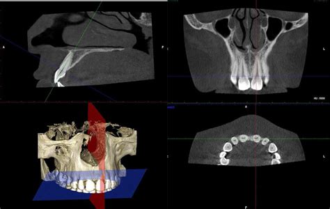 Orientation Of The Cbct Image For Bone Thickness Measurements