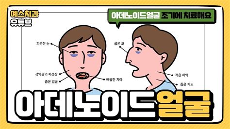 아데노이드 얼굴도 프리올소로 치료가 가능하다고 대박 ㅣ부산치아교정ㅣ프리올소장치ㅣ아데노이드얼굴ㅣ구호흡ㅣ비염 💘서면예스치과 💘