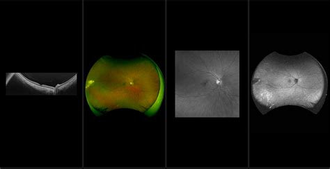 Silverstone Choroidal Rupture With Vitreous Hemorrhage Rg Af Oct