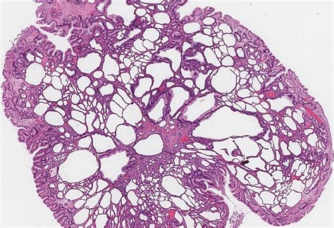 Your Pathology Report For Hyperplastic Polyp Of The Stomach Mypathologyreport
